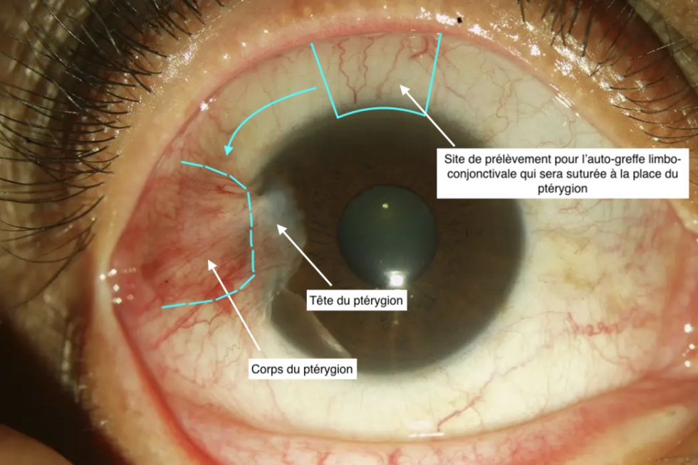 Maladies des Yeux La Réunion & Chirurgie • Ouest Vision